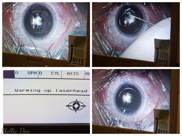 Joffe Medicenter | Houston, Texas | Lasik | Procedure Monitor